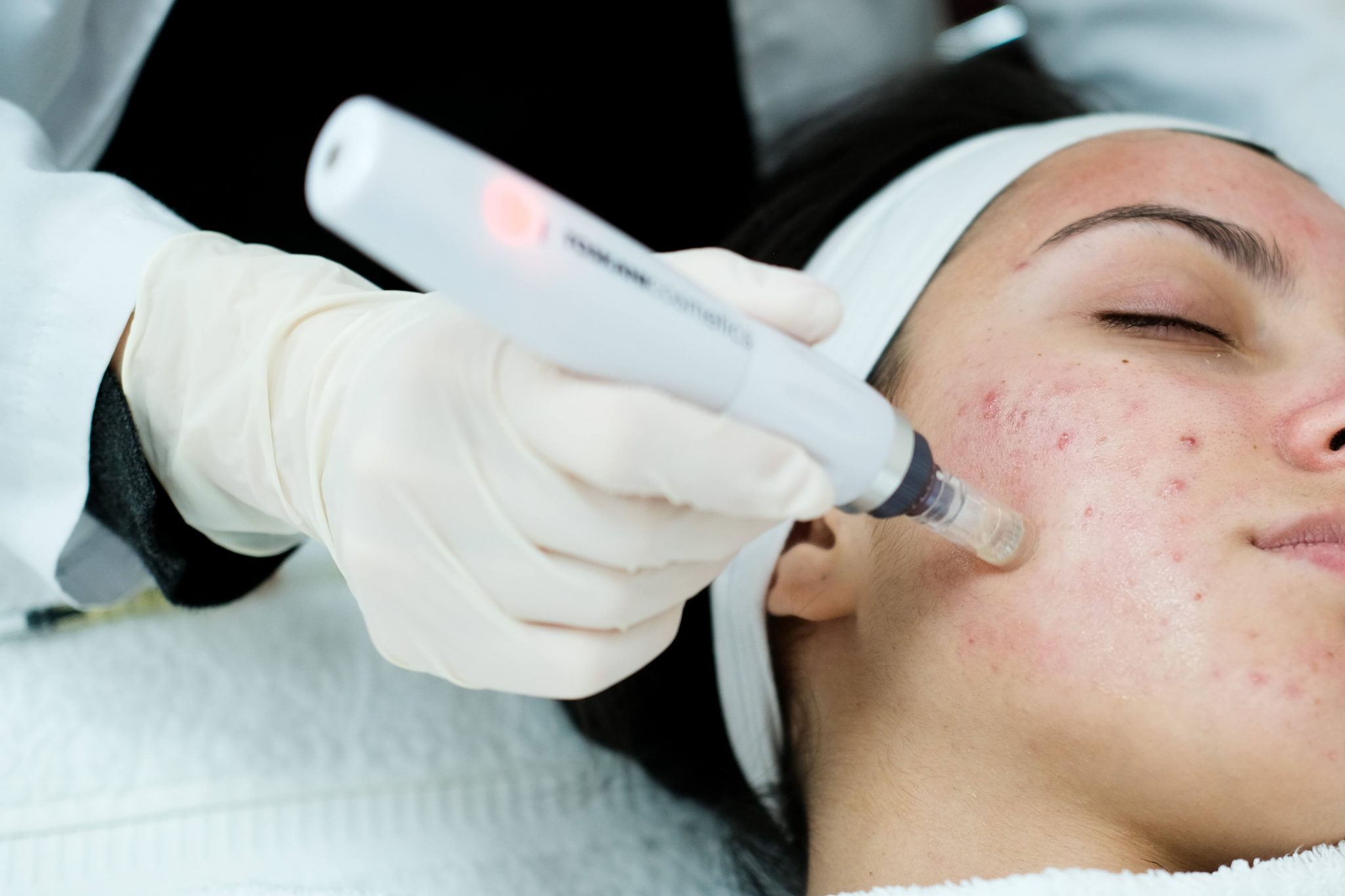 Microneedling - Osita Health Clinic